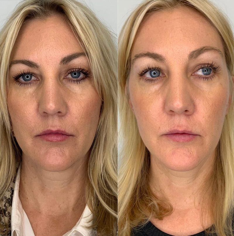 Before and After - Stella Capri